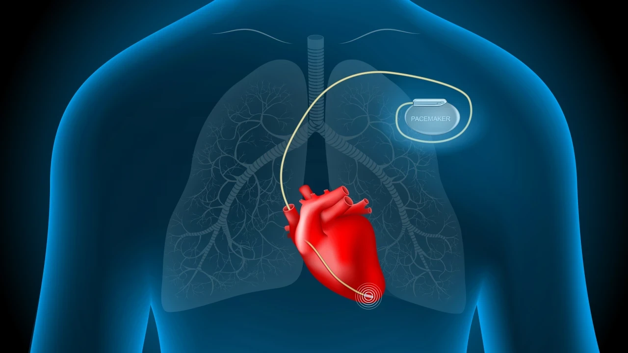 Pacemaker Explained: How It Restores Heart Rhythm & Energy